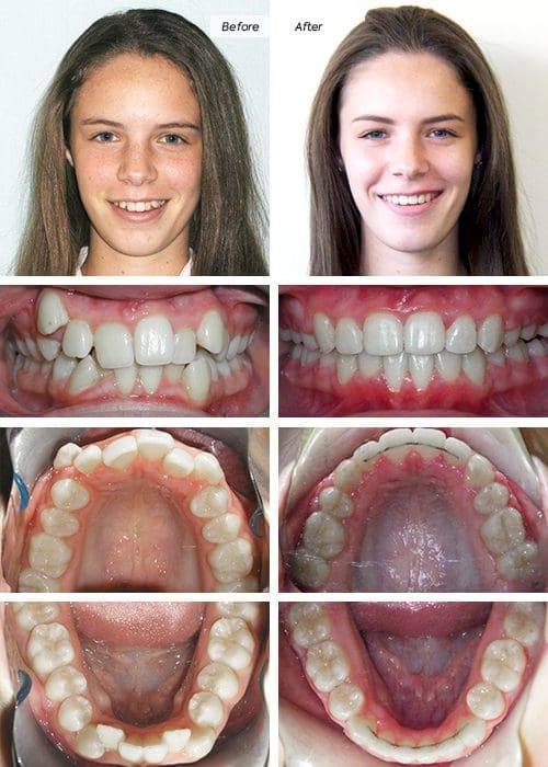 Early Orthodontic Treatment | Parker Orthodontics - Preventative Care ...